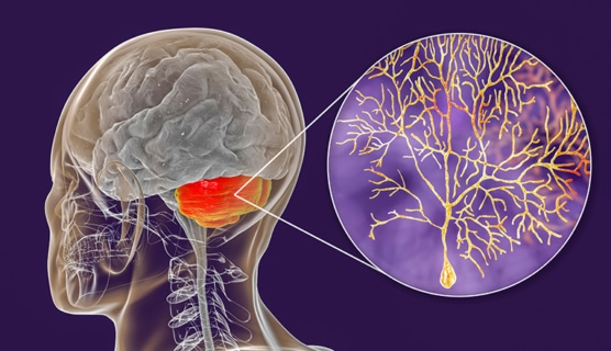 Wat is ataxie & wat zijn de behandelmogelijkheden? - Otolift