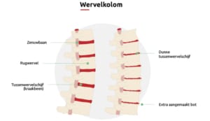 Wat zijn symptomen van artrose in de rug? - Otolift