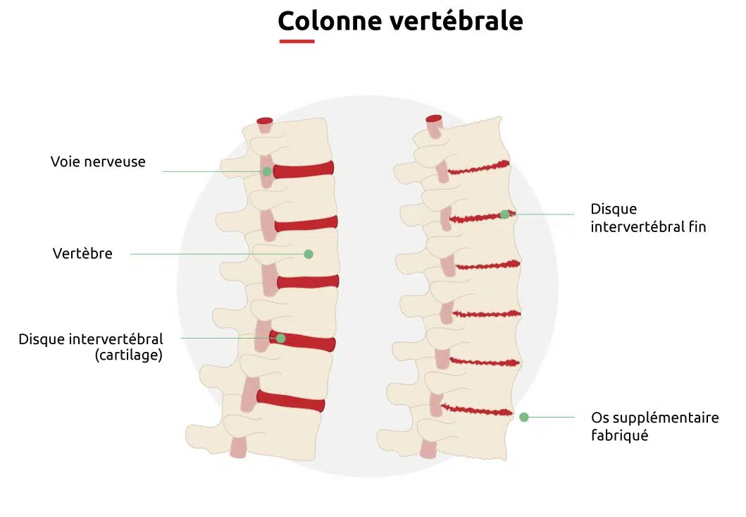 Quels sont les symptômes de l'arthrose du dos ? - Otolift