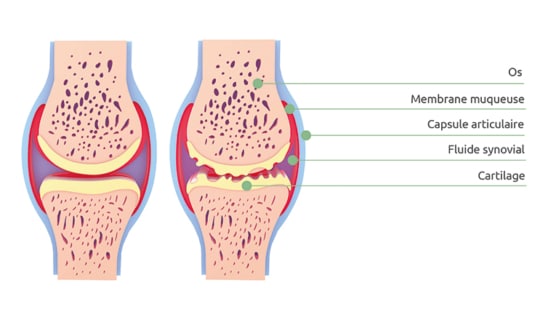 L'arthrose, c'est quoi au juste ? - Monte-escaliers Otolift